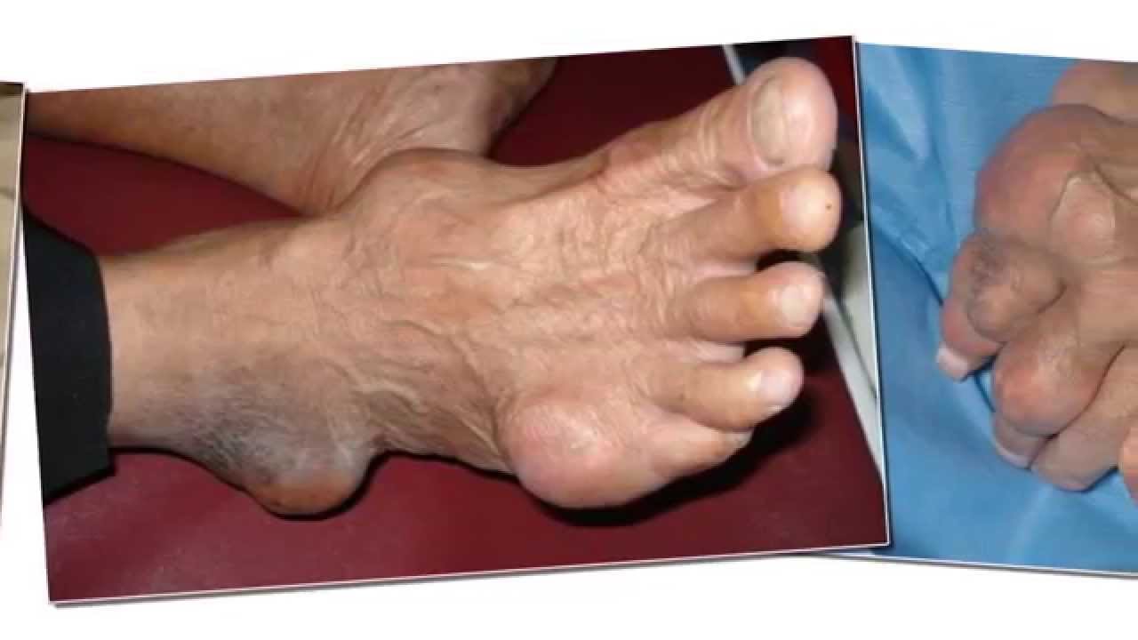 The Link Between Tophi And Gout - Get Rid Of Gout