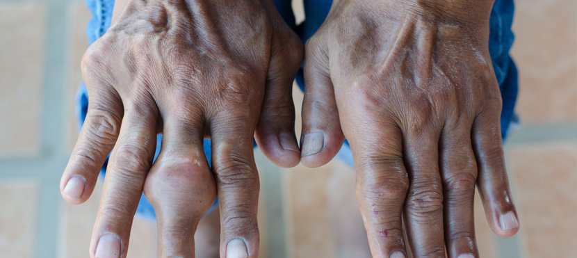 Things You Need To Know About Gout - Get Rid Of Gout