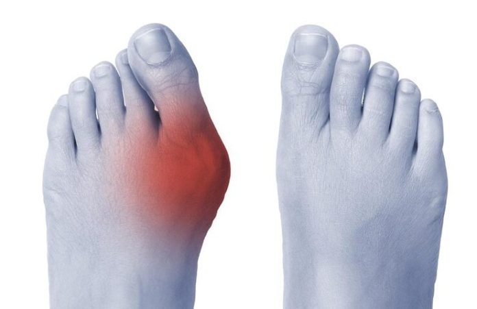 Gout vs. Bunions: Key Differences And How to Deal With Gout And bunions