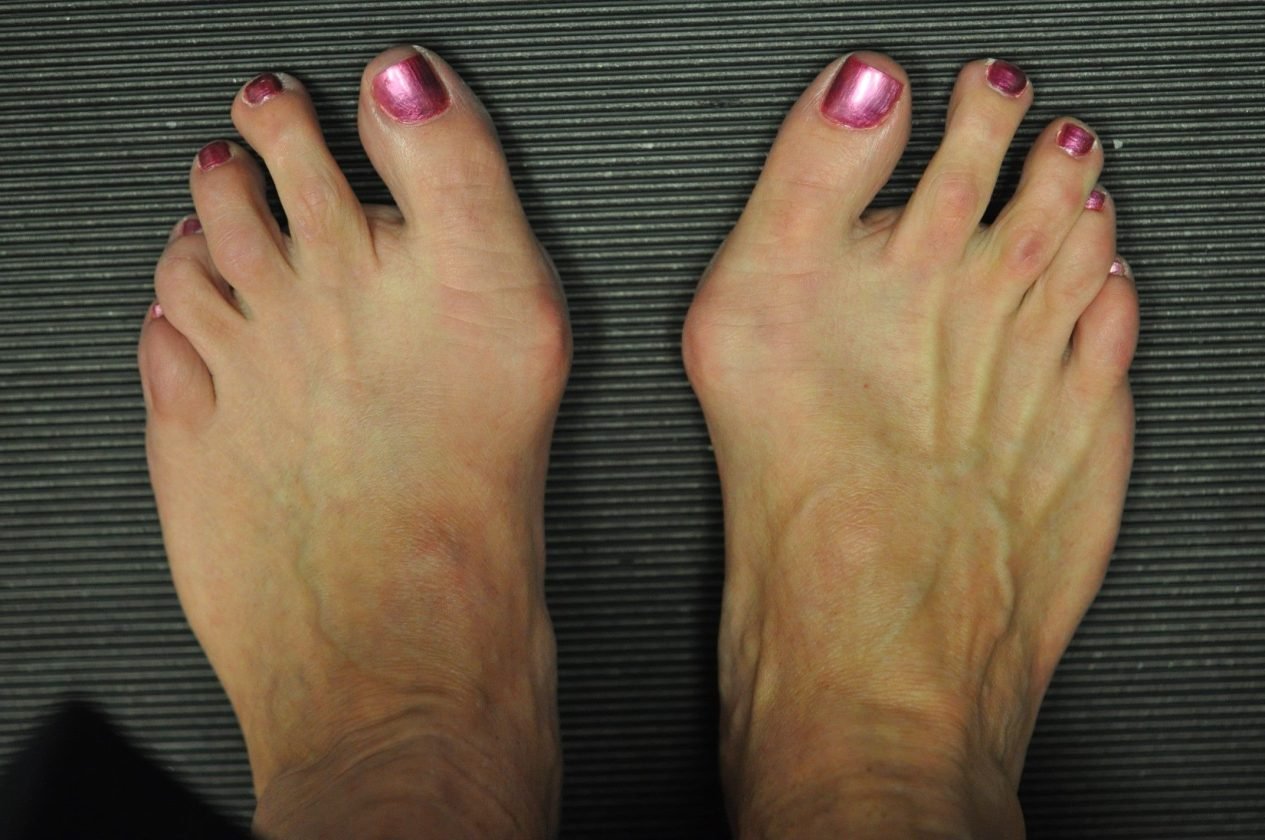 Gout vs. Bunions: Key Differences And How to Deal With Gout And bunions