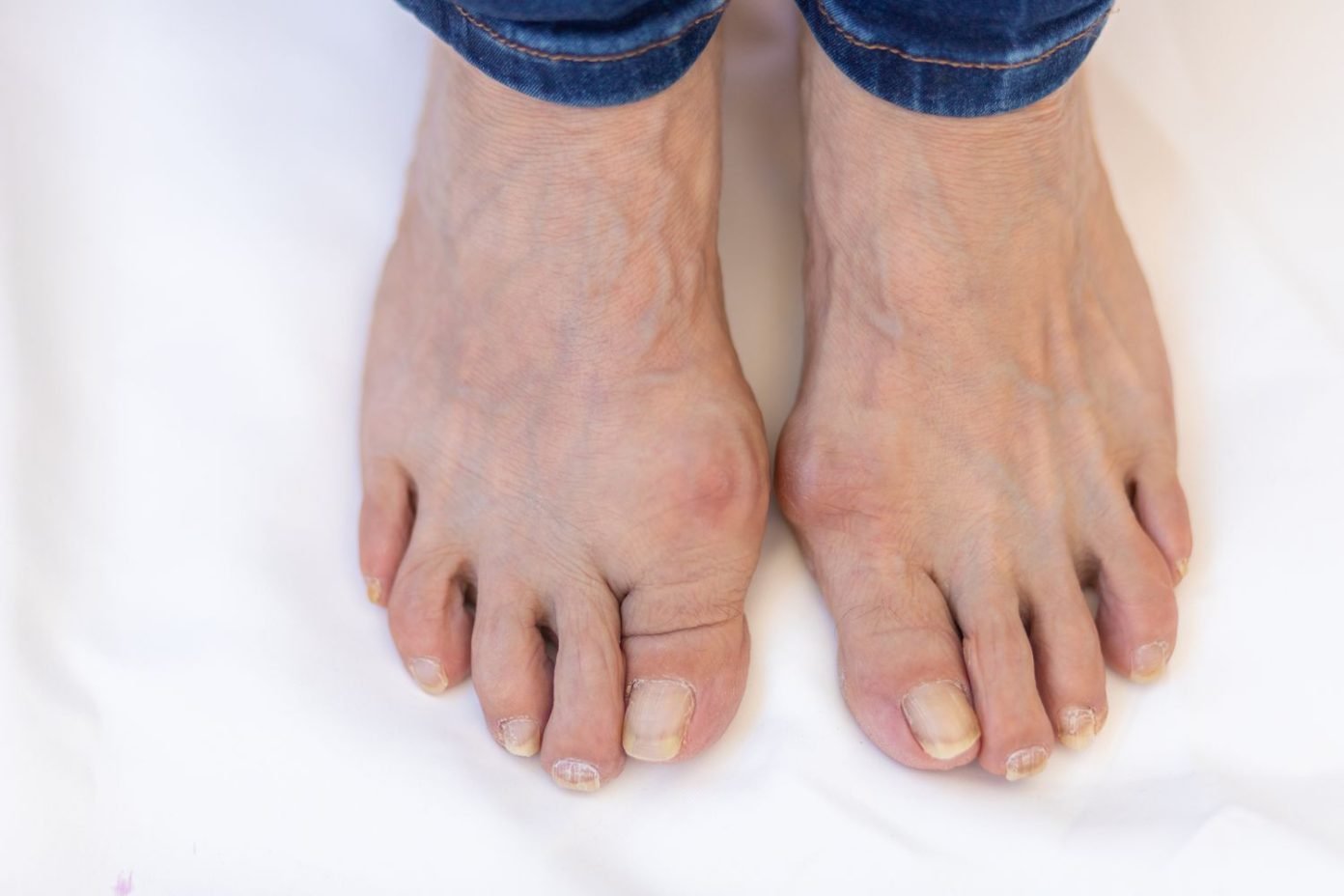 Gout vs. Bunions: Key Differences And How to Deal With Gout And bunions