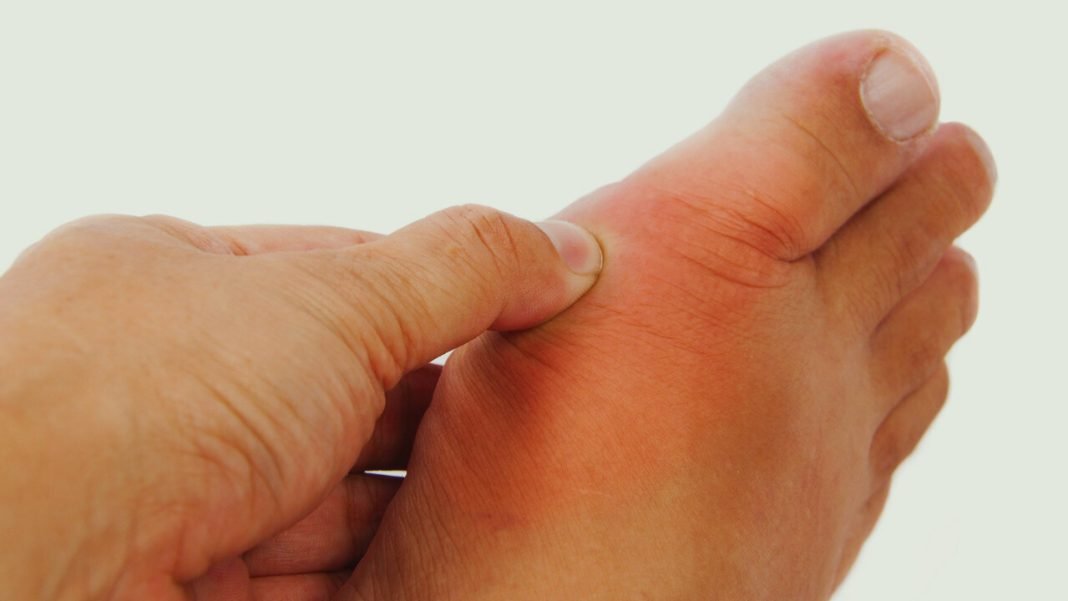 The Beef And Gout Diet: Unraveling The Purine Dilemma